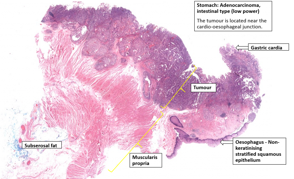 Stomach – Carcinoma – NUS Pathweb :: NUS Pathweb