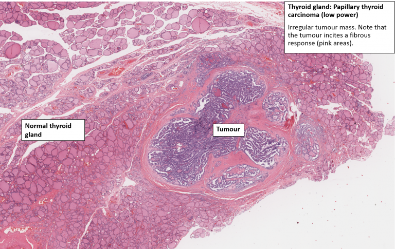 Thyroid – Papillary Carcinoma – NUS Pathweb :: NUS Pathweb