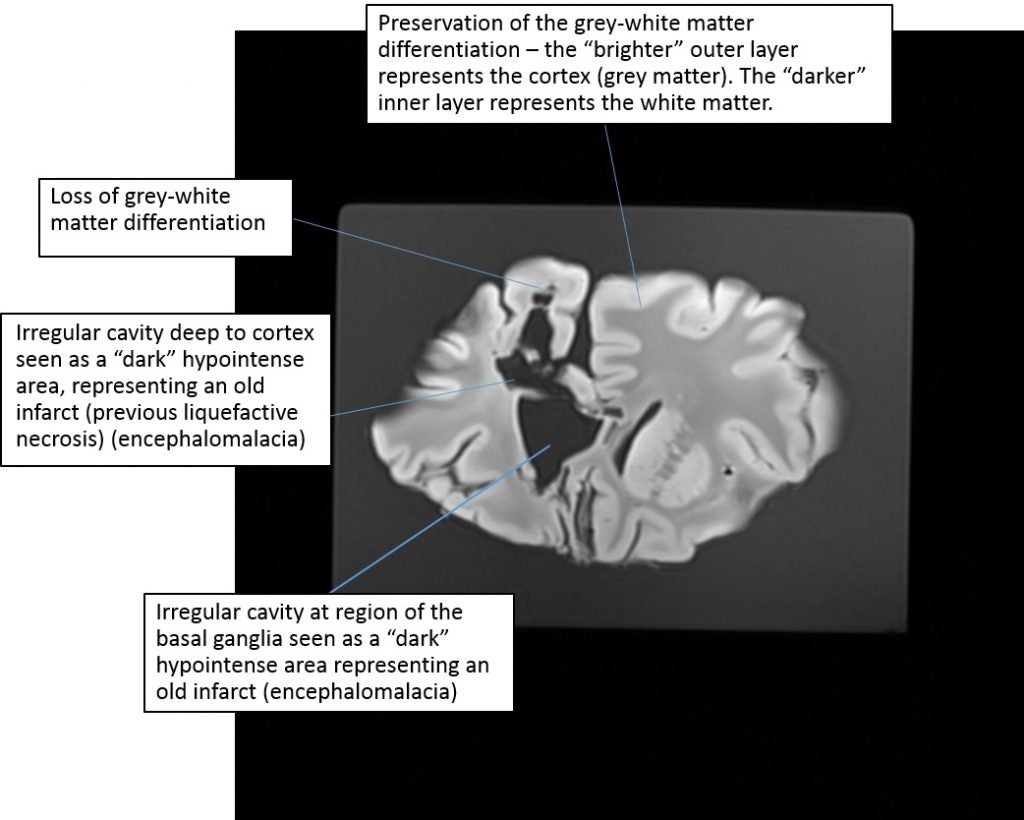 Brain – Infarct – NUS Pathweb :: NUS Pathweb
