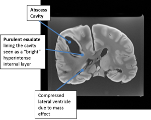Brain – Abscess – NUS Pathweb :: NUS Pathweb