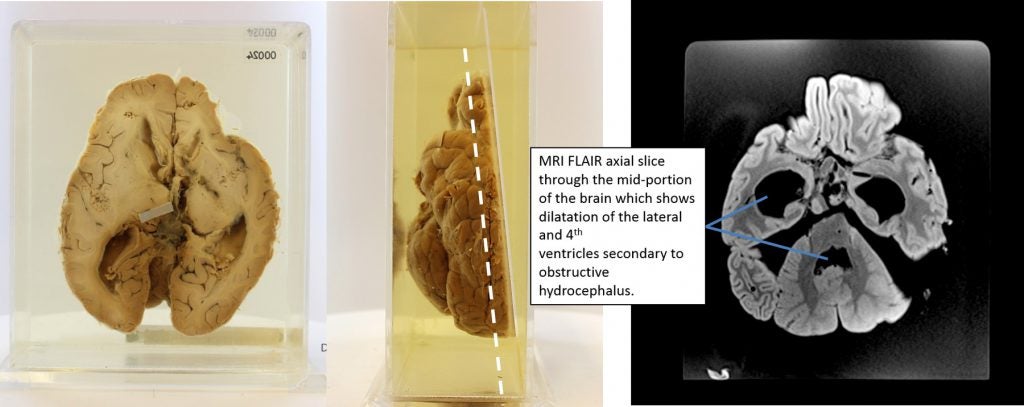 Brain – Tuberculous Meningitis – NUS Pathweb :: NUS Pathweb