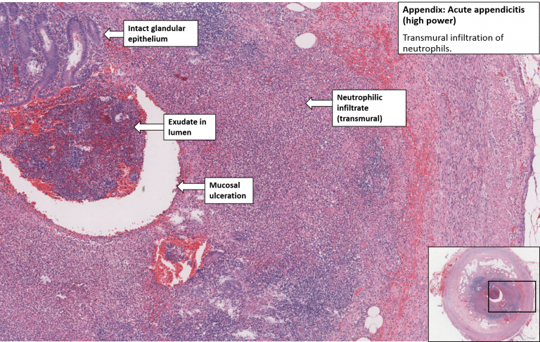 Appendix – Acute Appendicitis – NUS Pathweb :: NUS Pathweb