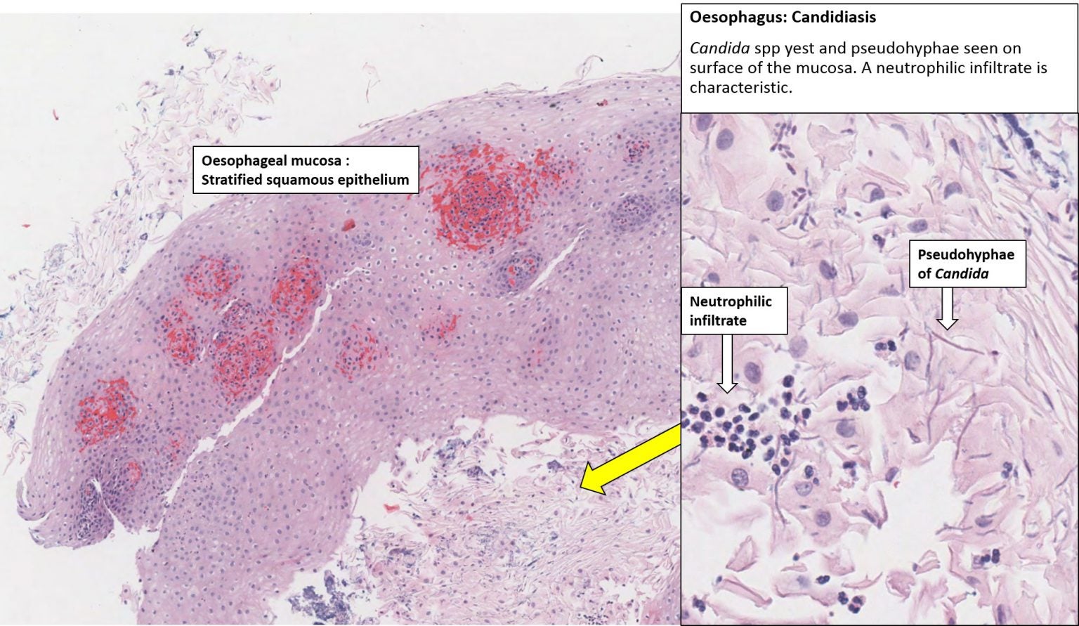 Oesophagus – Candidiasis (Moniliasis) – NUS Pathweb :: NUS Pathweb