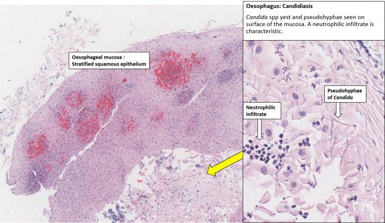 Oesophagus – Candidiasis (Moniliasis) – NUS Pathweb :: NUS Pathweb