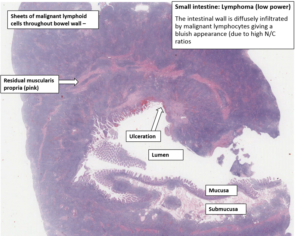 Small Intestine – Lymphoma – NUS Pathweb :: NUS Pathweb