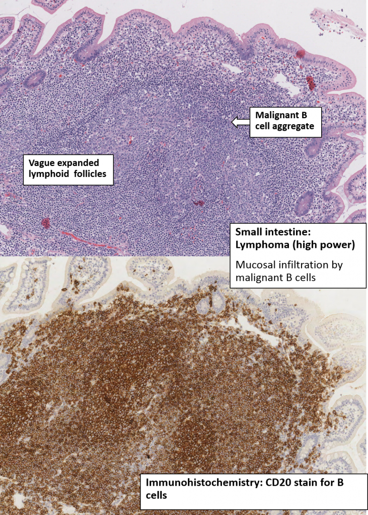 Small Intestine – Lymphoma – NUS Pathweb :: NUS Pathweb