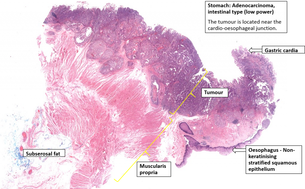 Stomach – Carcinoma (Linitis Plastica) – NUS Pathweb :: NUS Pathweb