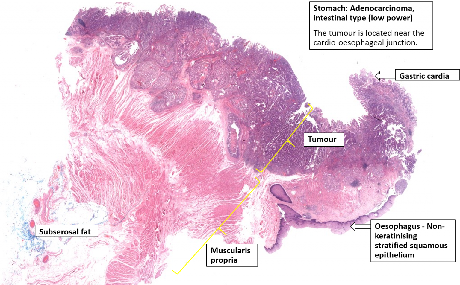 Stomach – Carcinoma (Linitis Plastica) – NUS Pathweb :: NUS Pathweb