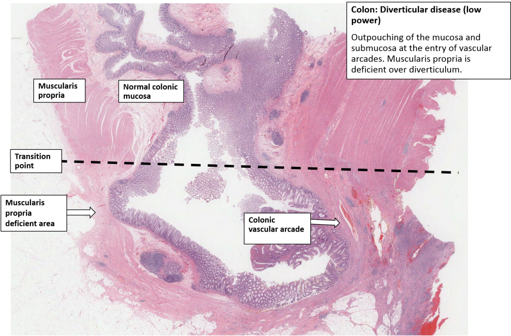Large Intestine – Diverticular Disease – NUS Pathweb :: NUS Pathweb