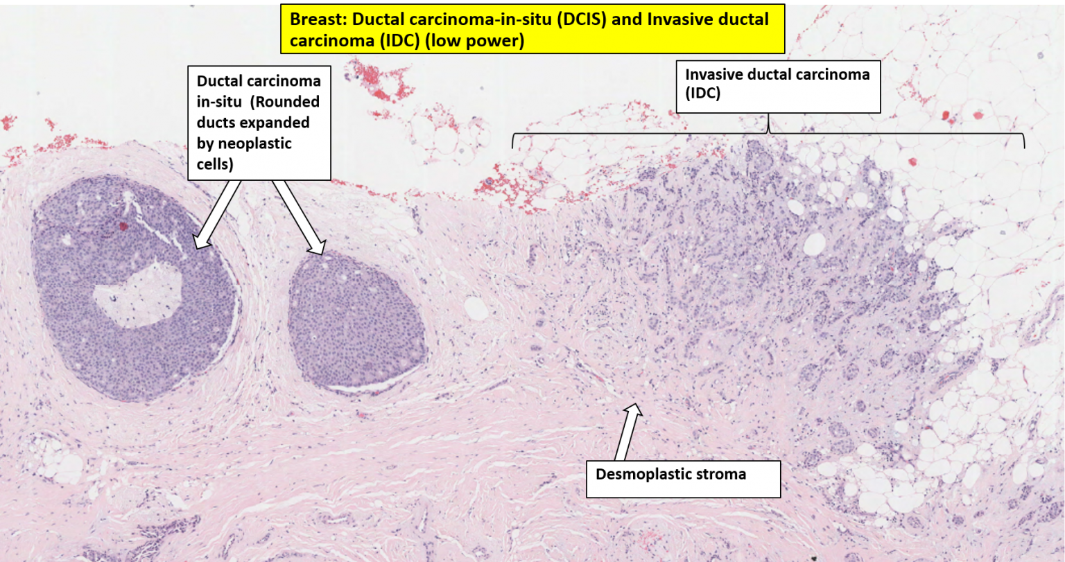 Breast – Carcinoma – NUS Pathweb :: NUS Pathweb