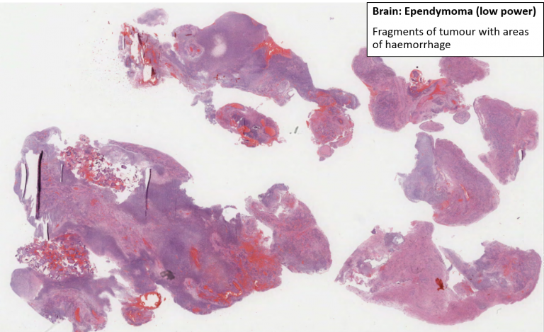 Brain – Ependymoma with Hydrocephalus – NUS Pathweb :: NUS Pathweb