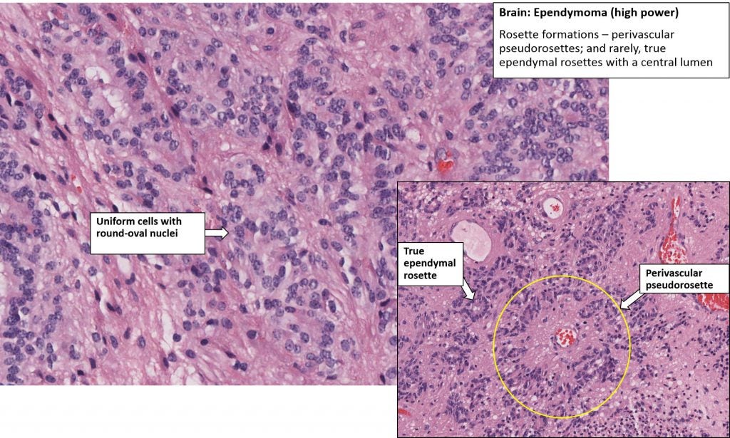 Brain – Ependymoma with Hydrocephalus – NUS Pathweb :: NUS Pathweb