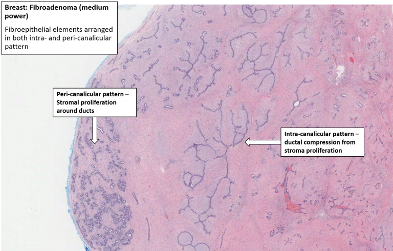 Breast – Fibroadenoma – NUS Pathweb :: NUS Pathweb