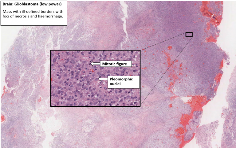 Brain – Glioblastoma – NUS Pathweb :: NUS Pathweb