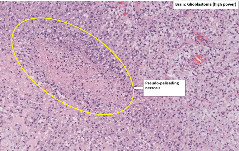 Brain – Glioblastoma – NUS Pathweb :: NUS Pathweb