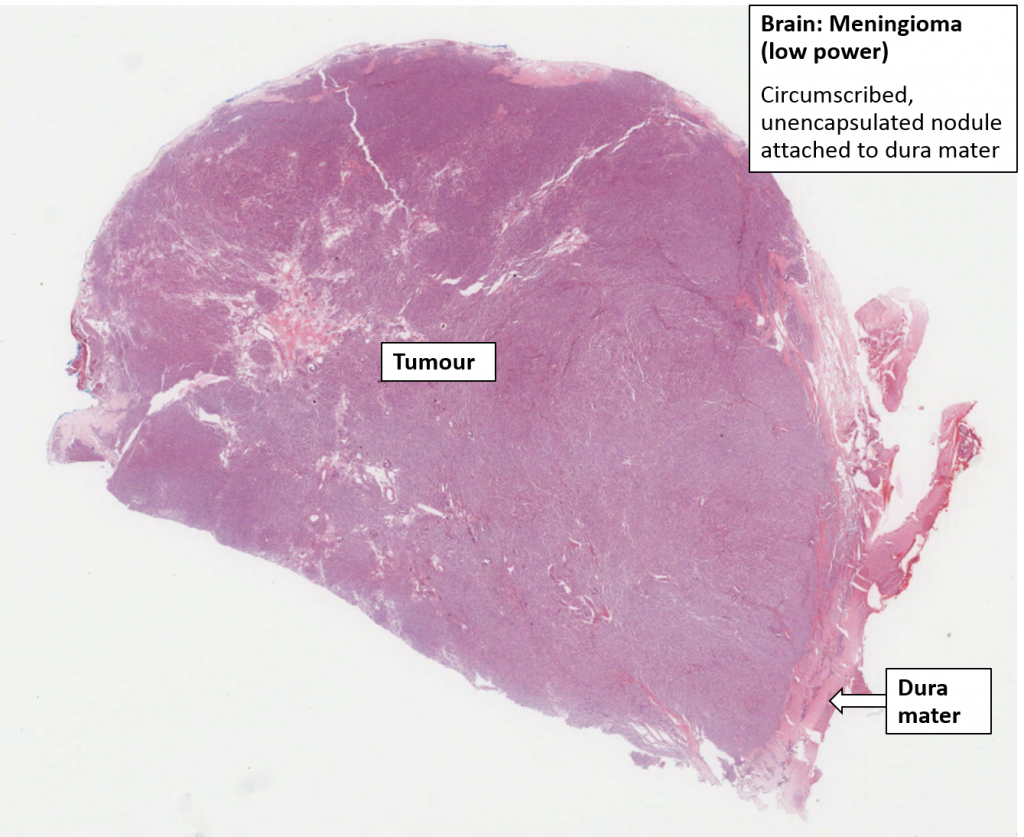 Brain – Meningioma – NUS Pathweb :: NUS Pathweb