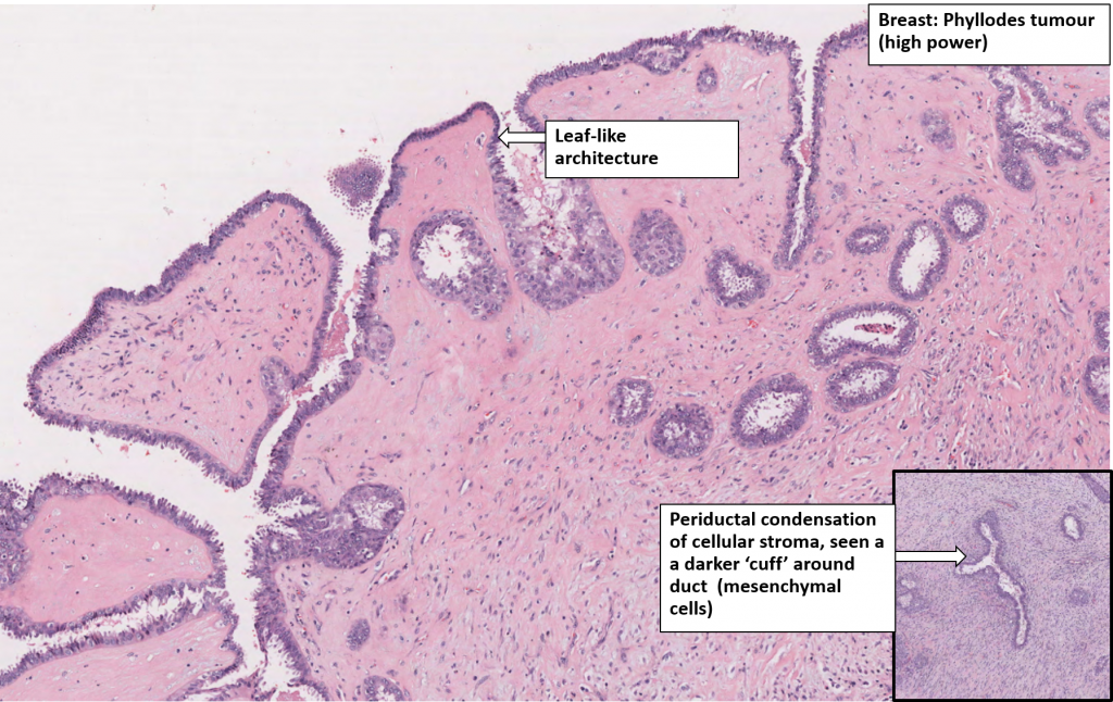 Breast – Phyllodes Tumour – NUS Pathweb :: NUS Pathweb