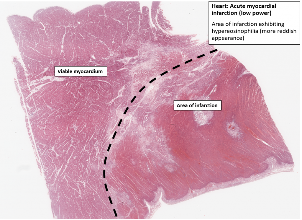 Heart – Myocardial infarct – NUS Pathweb :: NUS Pathweb