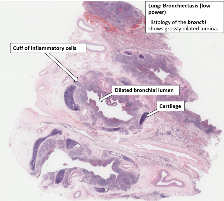 Lung – Bronchiectasis – NUS Pathweb :: NUS Pathweb