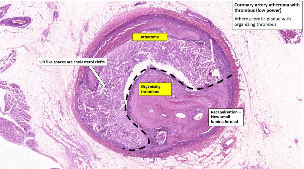 Aorta – Atherosclerosis – NUS Pathweb :: NUS Pathweb