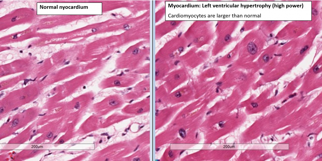 Heart – Left Ventricular Hypertrophy – NUS Pathweb :: NUS Pathweb