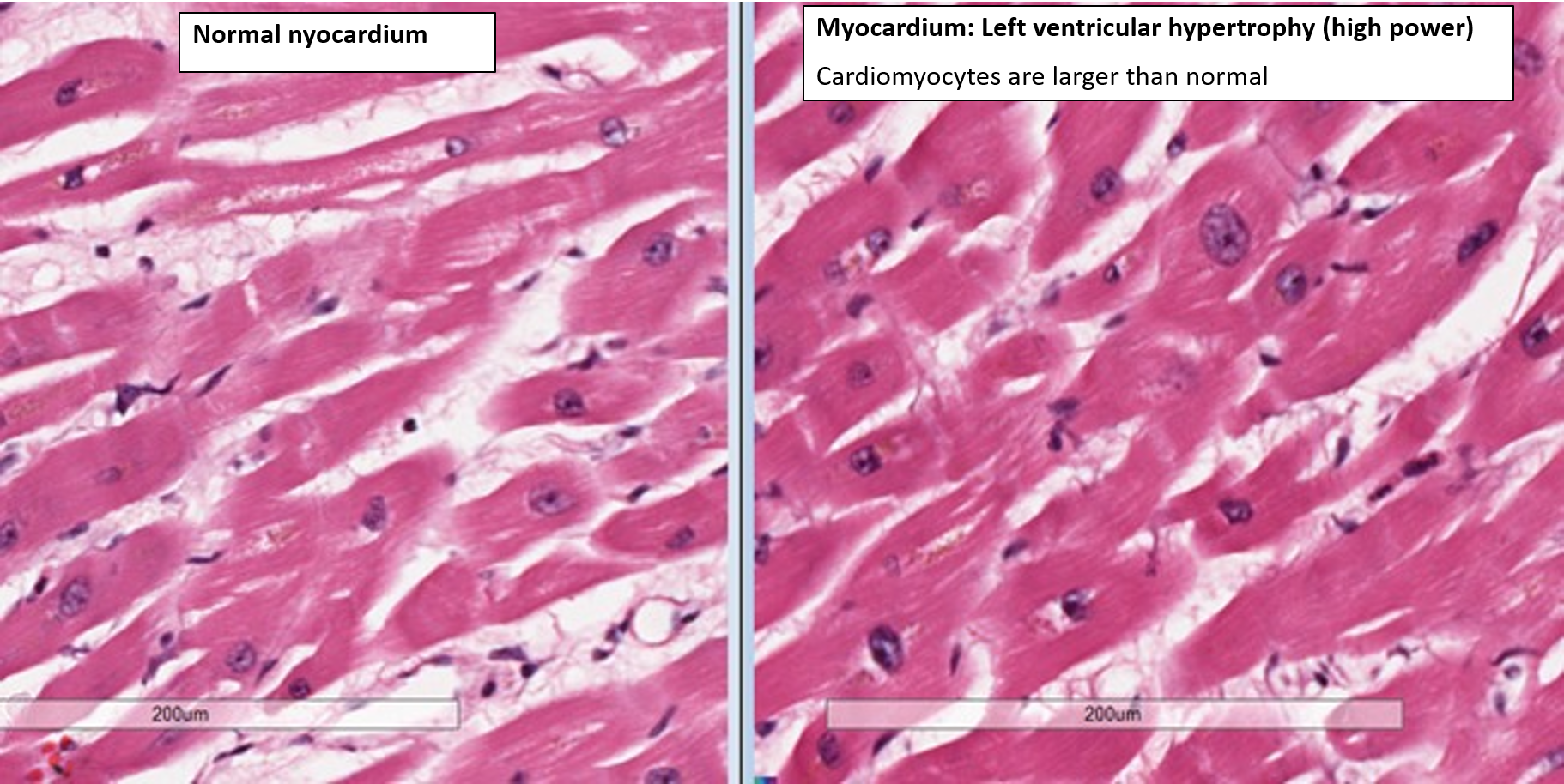 Pathological Hypertrophy Heart Diagram Richkery Pathological Hypertrophy Heart Diagram Richkery