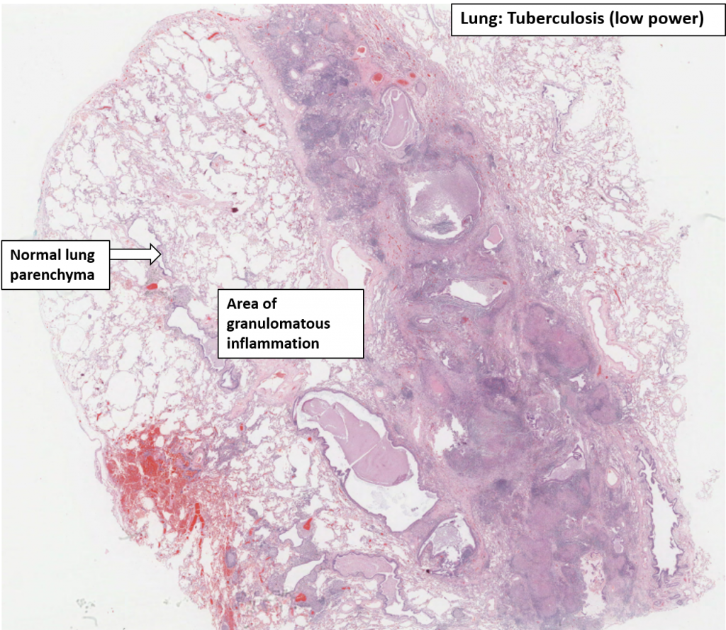 Lung – Tuberculosis – NUS Pathweb :: NUS Pathweb