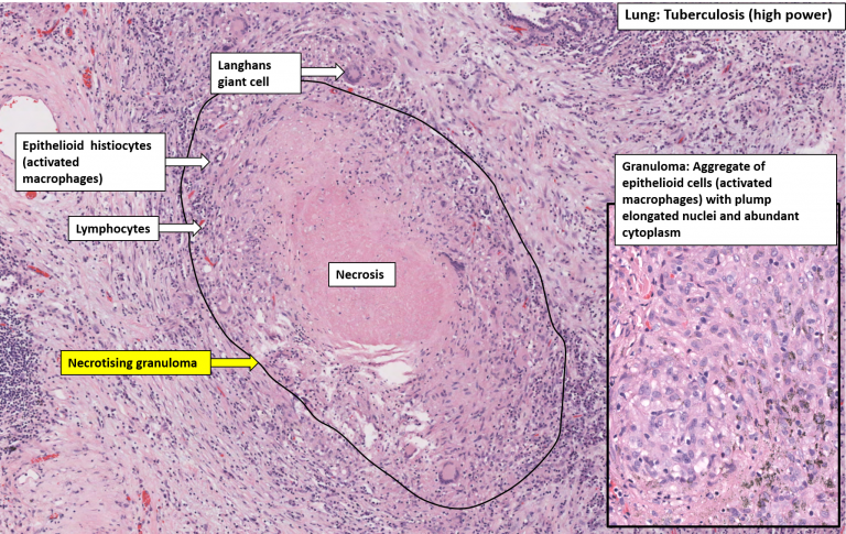 Lung – Tuberculosis – NUS Pathweb :: NUS Pathweb