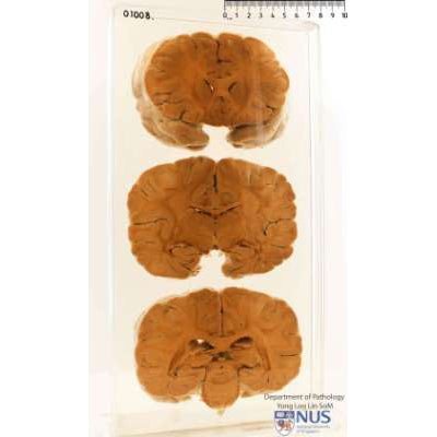 Central Nervous System Nus Pathweb Nus Pathweb