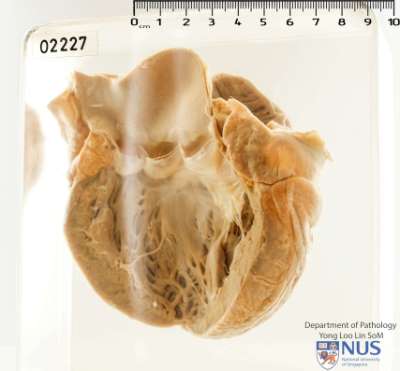 Cardiovascular System – NUS Pathweb :: NUS Pathweb