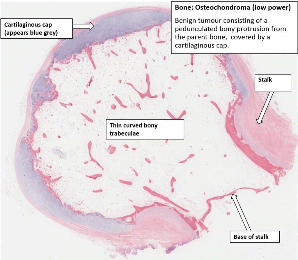 Bone – Osteochondroma – NUS Pathweb :: NUS Pathweb