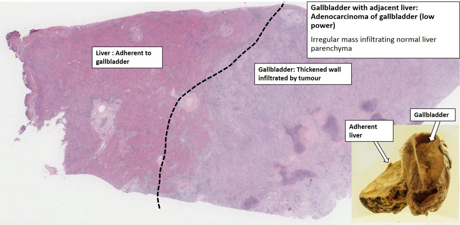 Gallbladder – Carcinoma – NUS Pathweb :: NUS Pathweb