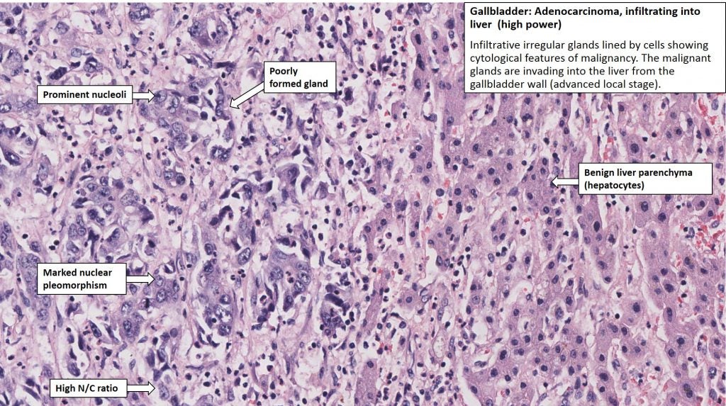 Gallbladder Carcinoma Nus Pathweb Nus Pathweb