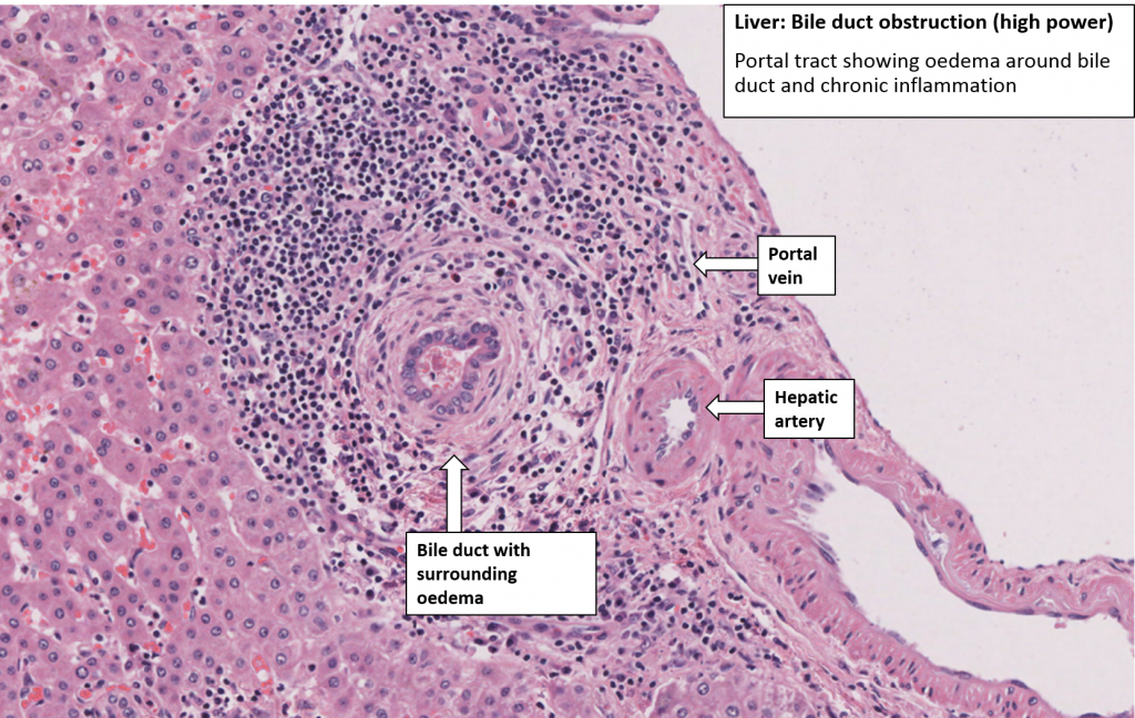Liver – Choledocholithiasis – NUS Pathweb :: NUS Pathweb