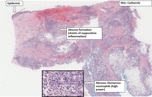 Skin – Carbuncle – NUS Pathweb :: NUS Pathweb