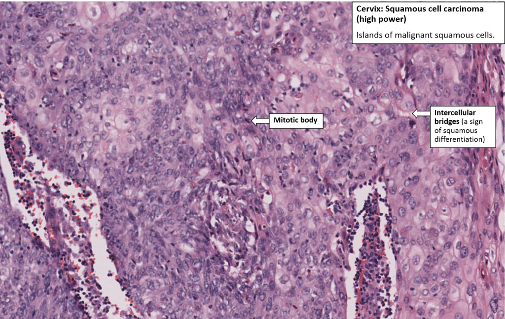 Uterus – Cervical Carcinoma – NUS Pathweb :: NUS Pathweb