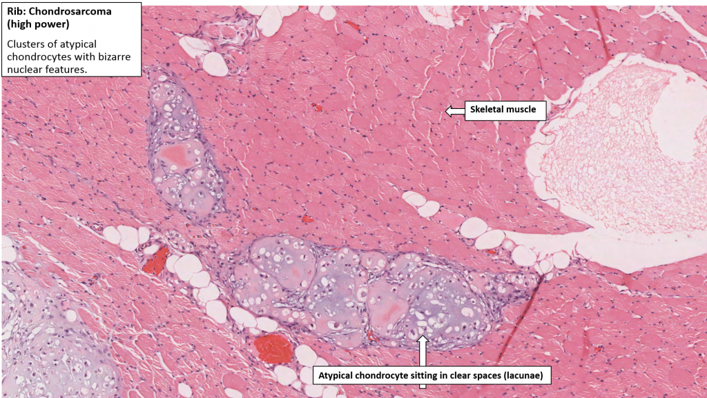 Rib – Chondrosarcoma – NUS Pathweb :: NUS Pathweb