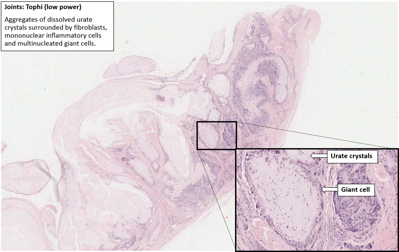Finger – Gout – NUS Pathweb :: NUS Pathweb
