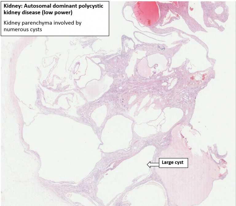 Liver, Pancreas and Kidney – Polycystic Disease – NUS Pathweb :: NUS ...