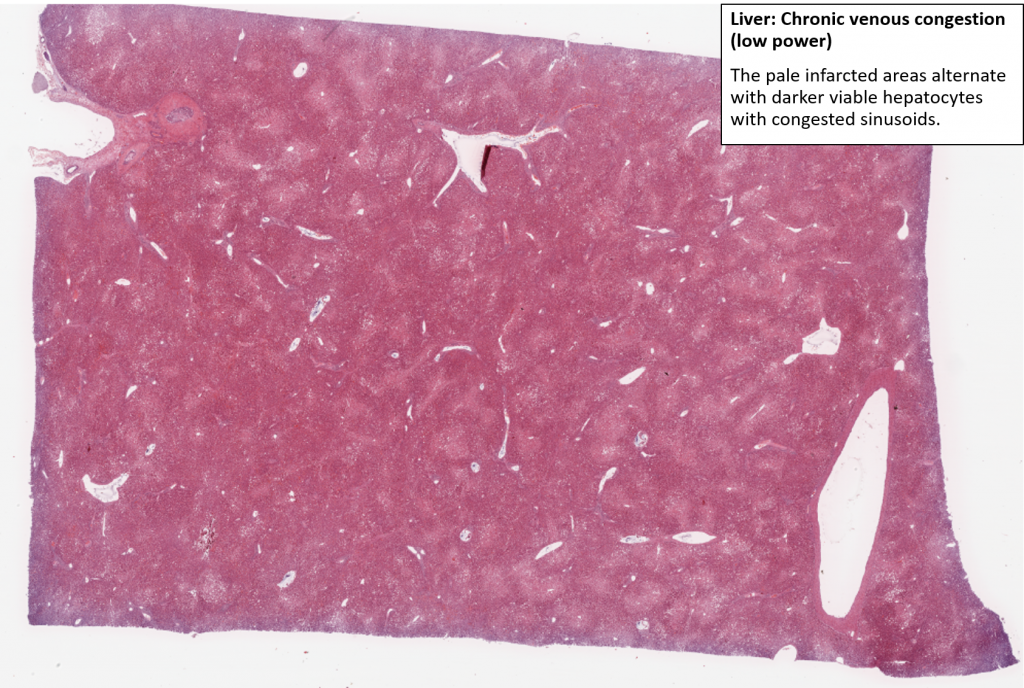 Liver – Chronic Venous Congestion – NUS Pathweb :: NUS Pathweb