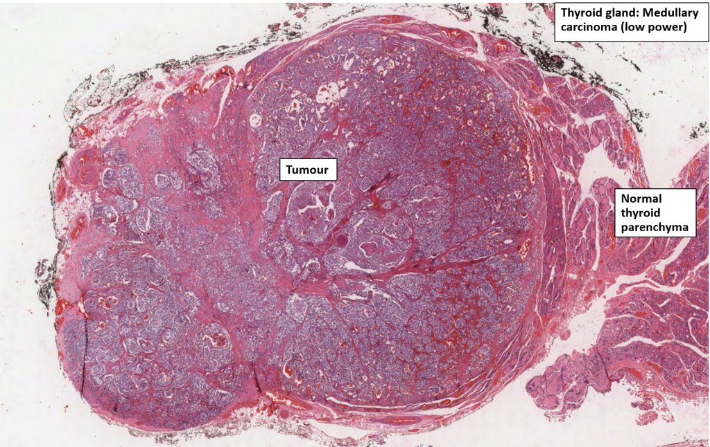 Thyroid – Medullary Carcinoma – NUS Pathweb :: NUS Pathweb
