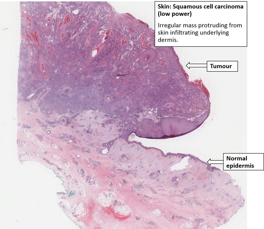 Skin – Squamous Cell Carcinoma – NUS Pathweb :: NUS Pathweb