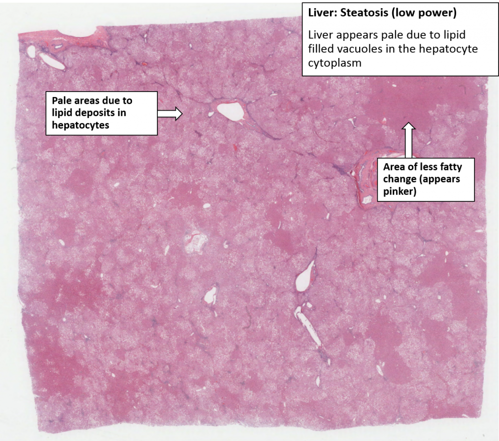 Liver – Fatty Change – NUS Pathweb :: NUS Pathweb