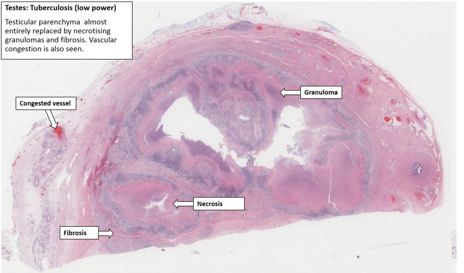 Testis – Tuberculosis – NUS Pathweb :: NUS Pathweb