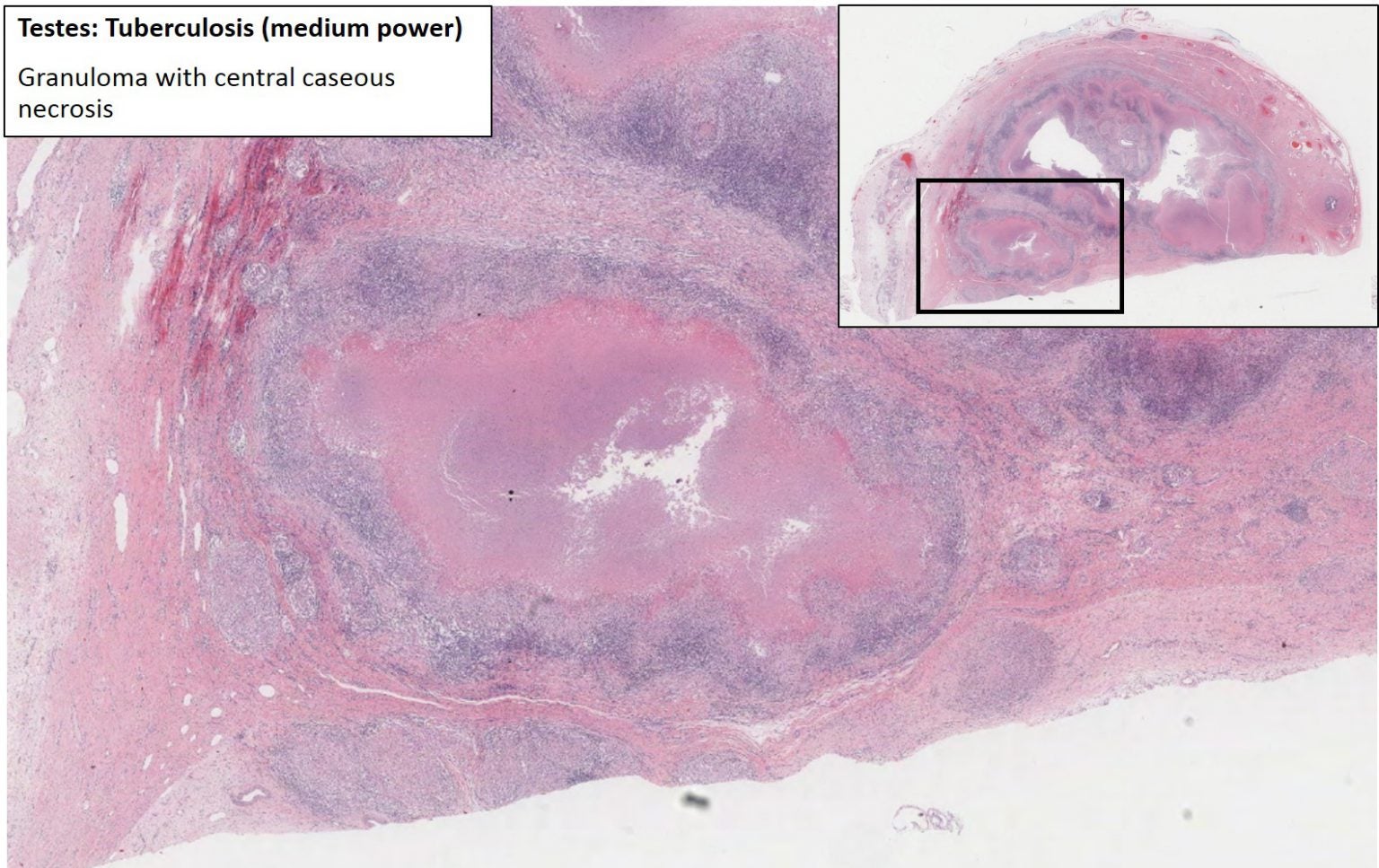 Testis – Tuberculosis – NUS Pathweb :: NUS Pathweb