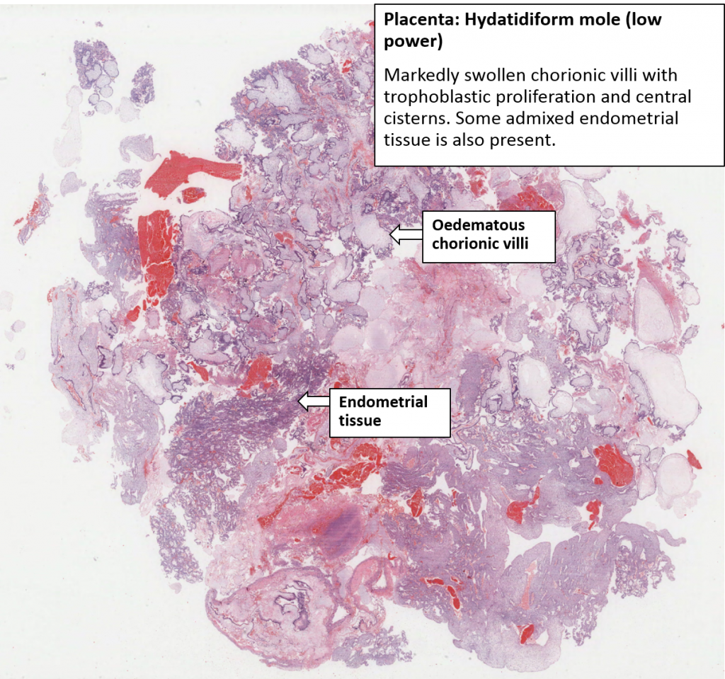 Uterus and Placenta – Hydatidiform Mole – NUS Pathweb :: NUS Pathweb