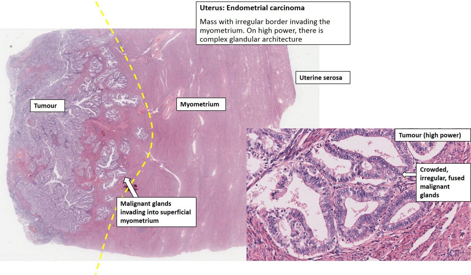 Uterus – Endometrial Carcinoma – NUS Pathweb :: NUS Pathweb