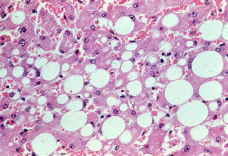 Hepatobiliary System – NUS Pathweb :: NUS Pathweb