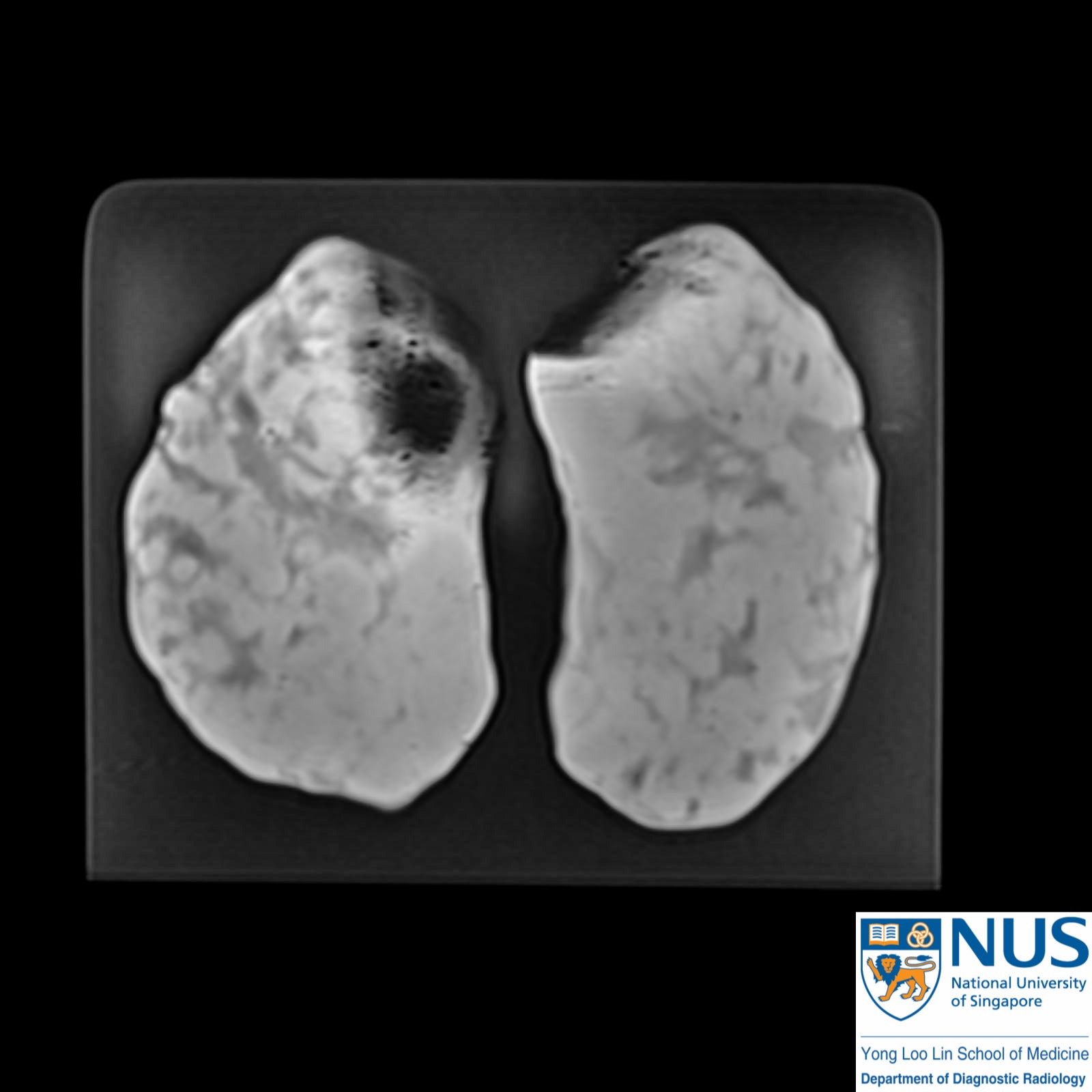 Systemic Pathology: Female Genital Tract – NUS Pathweb :: NUS Pathweb