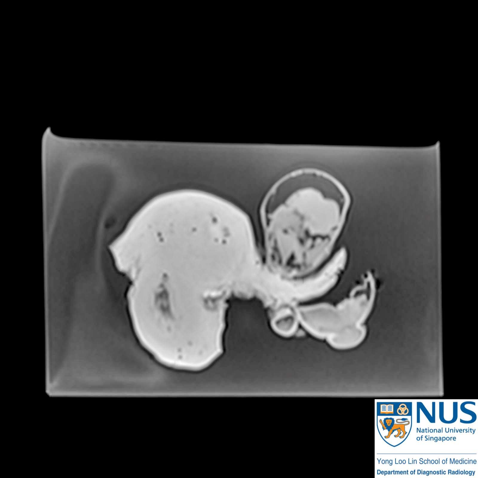 Systemic Pathology: Female Genital Tract – NUS Pathweb :: NUS Pathweb